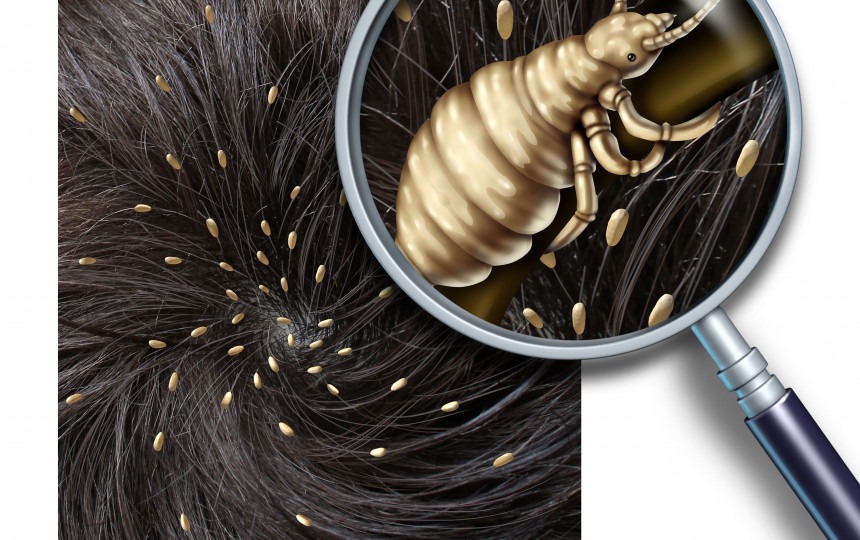 Pedikuliozė - kas tai? | Militra.lt